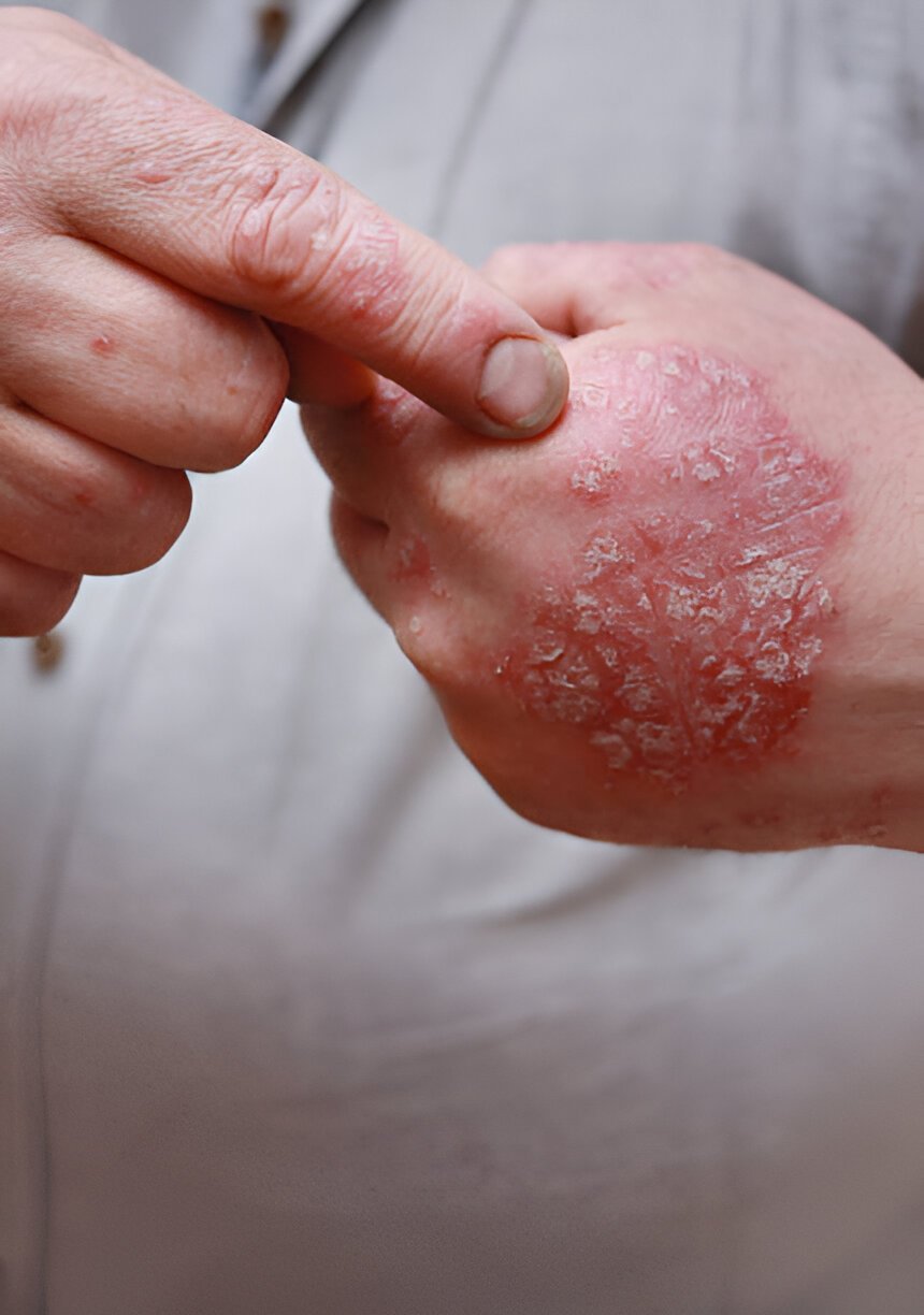 Skin Infections Treatment – Dermatology & Beyond